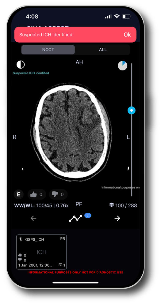 TeraRecon Neuro | AI-insight driven decision support for neurovascular emergencies